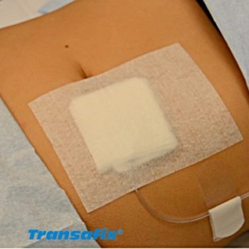 Sistema di fissaggio PEG – Coremec Srl – Presidi e Dispositivi Medico ...